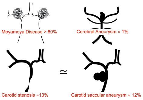 Saccular Aneurysm
