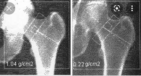 Bone Density Karen E Kennedy Md Gynecology
