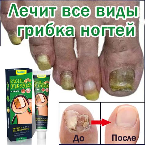 Мазь от грибка ногтей на ногах 30 г противогрибковое средство Алтея крем для ног от трещин
