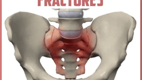 Sacral Area Edema