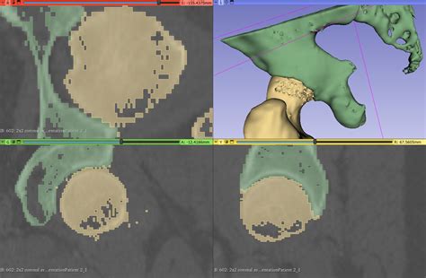 How Can I Fill A Hollow Area Present In A Femur Head Support 3d Slicer Community