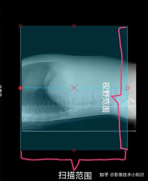 Ct的扫描野和显示野 知乎
