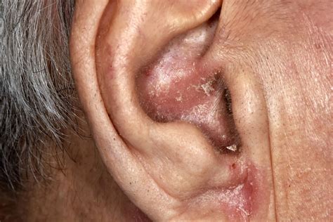 Ear Eczema Find Out Why Your Ears Might Be Itchy