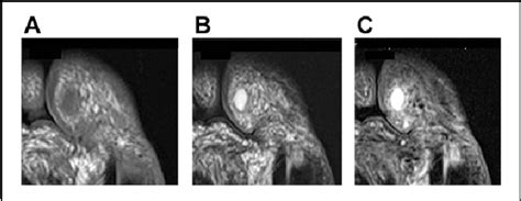 Figure 3 From Mucous Cyst At The Interphalangeal Joint Of The First Toe Caused By Contact