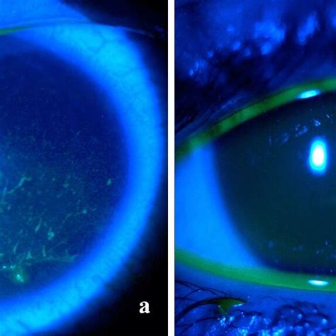 Anterior Segment Photograph Of The Right Eye Showing Punctate