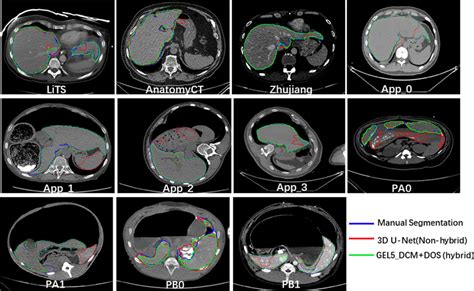 Visualization Segmentation Results Of Three Comparison Methods For Hard