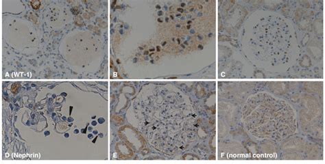 Detached And Capillary Attached Podocytes Were Positively Stained With Download Scientific