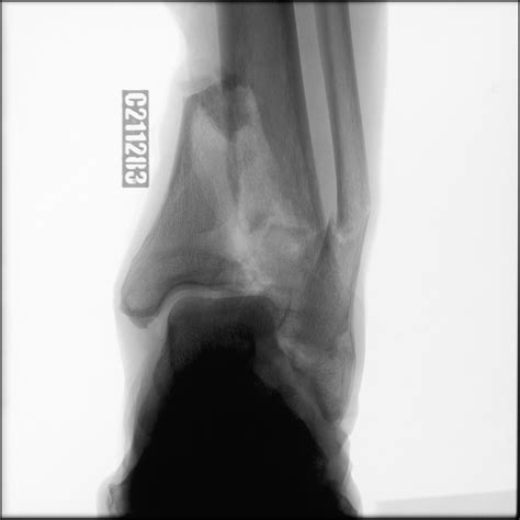 Preview Fracture Of Distal Tibiafibula Left