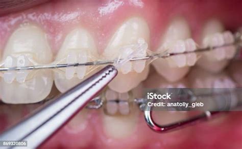 치과 세라믹 브라켓 이빨 치료 치과 사무실에서 모기를 사용 하 여 중괄호와 치아의 매크로 샷입니다 교정 치료입니다 치과 개인 장식품에 대한 스톡 사진 및 기타 이미지