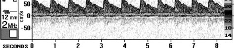 Pca Velocity Signals Are Recorded In The P2 Segment Upper Spectral Download Scientific Diagram