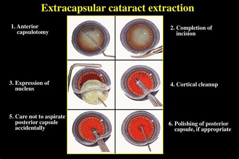 Ppt Acquired Cataract Powerpoint Presentation Id 1251889