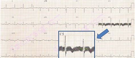 5060 Hz Ac Interference Artifact Ekg Ecg Ankara Kardiyoloji
