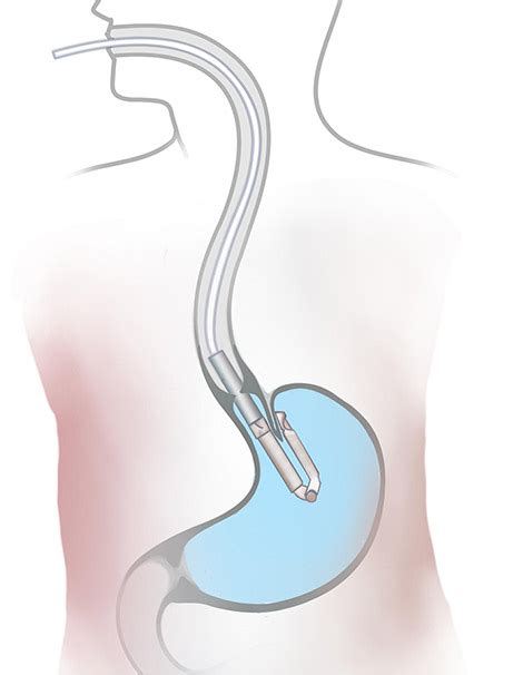About The Tif Procedure Transoral Incisionless Fundoplication