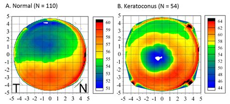 Word On The Street About Epithelial Mapping Eyeworld