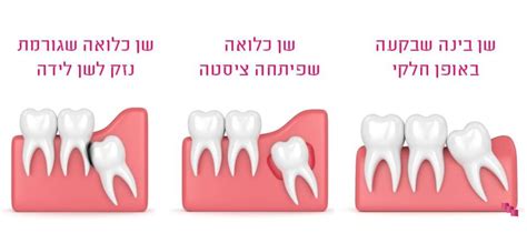 מחיר עקירת שן בינה כמה עולה עקירת שן בינה במידרג