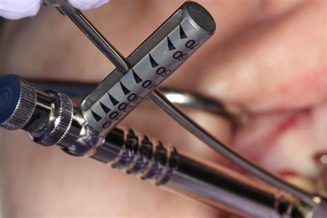 Osteogen Plugs The One Step Bone Graft Solution For Socket Preservation