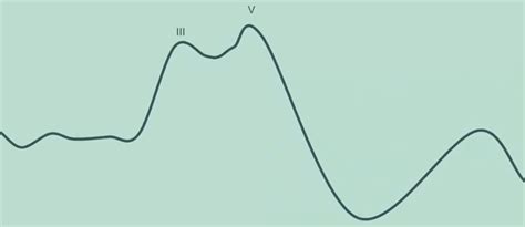 Threshold Auditory Brainstem Response Abr Testing Interacoustics