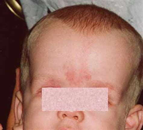 Prader Willi Syndrome Medlineplus Genetics