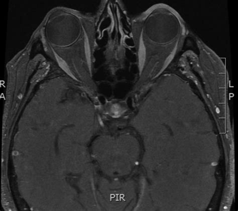 Oculomotor Synkinesis Aberrant Reinnervation Of The Third Cranial