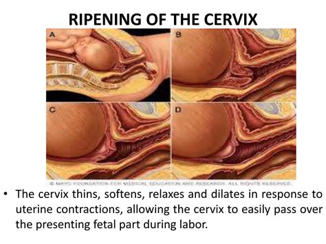 Cervical Ripening And The Bishop Score Pptx