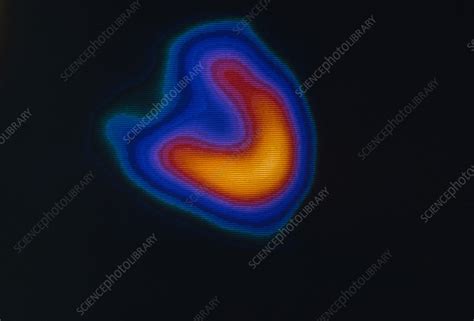 Abnormal Perfusion Scintigram Stock Image C004 7398 Science Photo Library