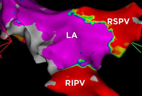 Pulsed Field Ablation Pfa Evidence Biosense Webster