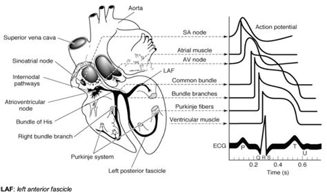 Ventricular Conduction Disorders In Pediatrics Bundle Branch Blocks