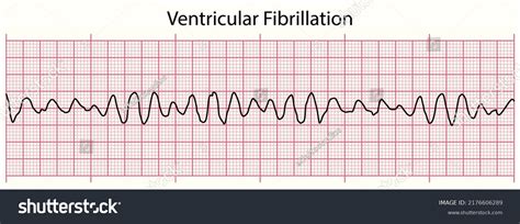 Ventricular Fibrillation Rhythm Strip