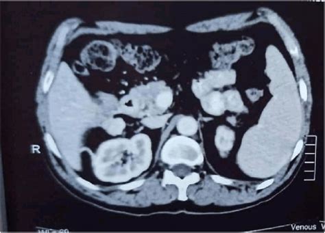 Ct Abdomen Showing Encapsulated Mass Arising From 2nd Part Of Duodenum Download Scientific