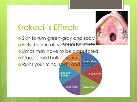 Ppt Understanding Krokodil The Flesh Eating Drug And Its Devastating