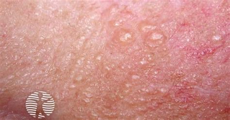 Adult Colloid Miliu Image