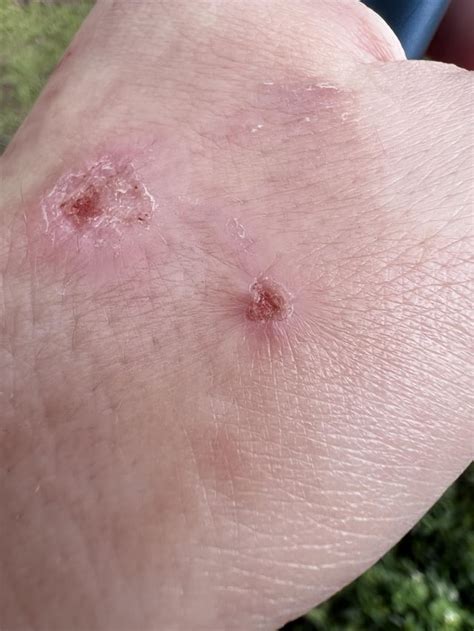 Scabies Or Something Else R Scabies