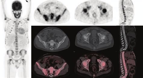 Mip Image Showing Increased Fdg Uptake In Axial And Appendicular Download Scientific Diagram