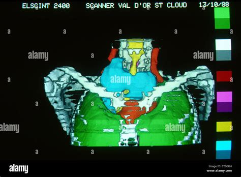 THYROID NODULE SCAN Stock Photo Alamy