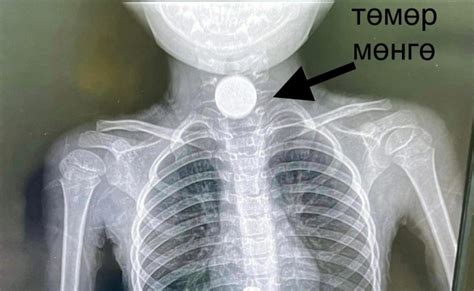 АНХААР ЭХЭМҮТ ийн эмч нар хүүхдийн улаан хоолойд тээглэсэн зоосыг авчээ E Mn