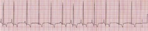Cardiac Arrhythmias Ecgs Flashcards Quizlet