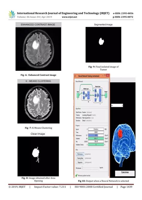 Irjet Mri Image Processing Operations For Brain Tumor Detection Pdf Photo Editing Software