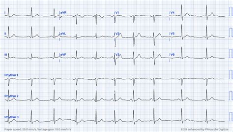 Normal Ecg By Computer Algorithm Archives Dr Smiths Ecg Blog