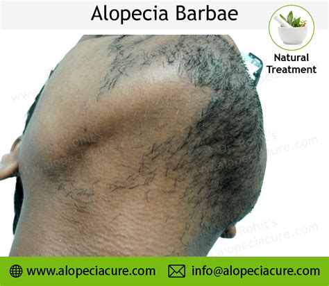 Alopecia Barbae
