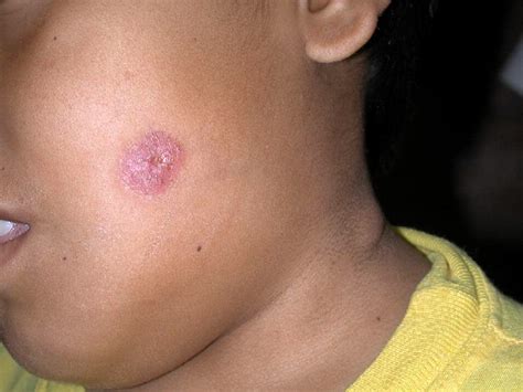 Cutaneous Tuberculosis Clinics In Dermatology