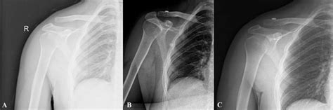 A Preoperative Radiograph Of Patient With Acute Right Acj Dislocation Download Scientific