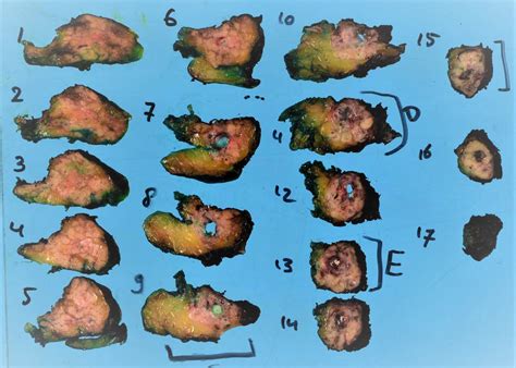 Robotic Spleen Preserving Distal Pancreatectomy The Warshaw And Kimura Techniques