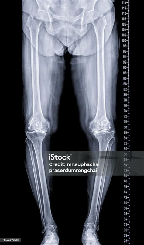 What Is A Scanogram X Ray At Mona Smith Blog