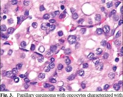 Figure 1 From The Oncocytic Variant Of Papillary Thyroid Carcinoma With Multifocal Involvement