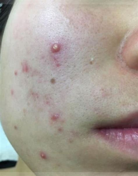 남자 여드름 화장품 지성피부 스킨로션 추천 네이버 블로그