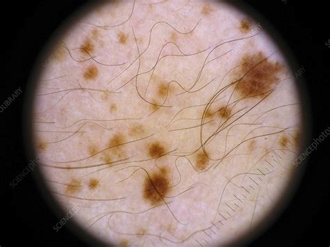 Nevus Spilus Stock Image C006 4037 Science Photo Library