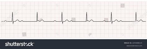 Ekg Showing Third Degree Complete Av Stock Vector Royalty Free
