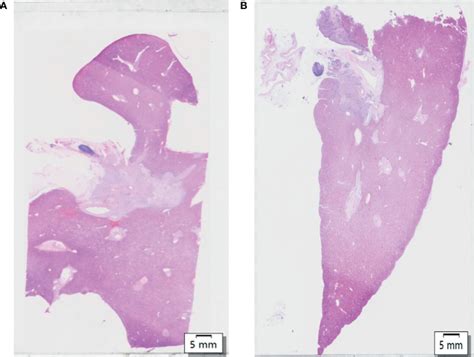 Characteristic Of Perineural Invasion In Hilar Cholangiocarcinoma Based On Whole Mount