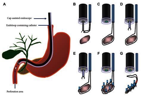 Illustration Of Cap Assisted Endoscopic Combination Therapy With