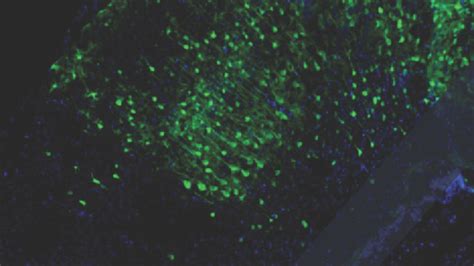 ‘seemingly Inconsequential Inherited Dna Mutation Triggers Sixfold Increase In Brain Tumour